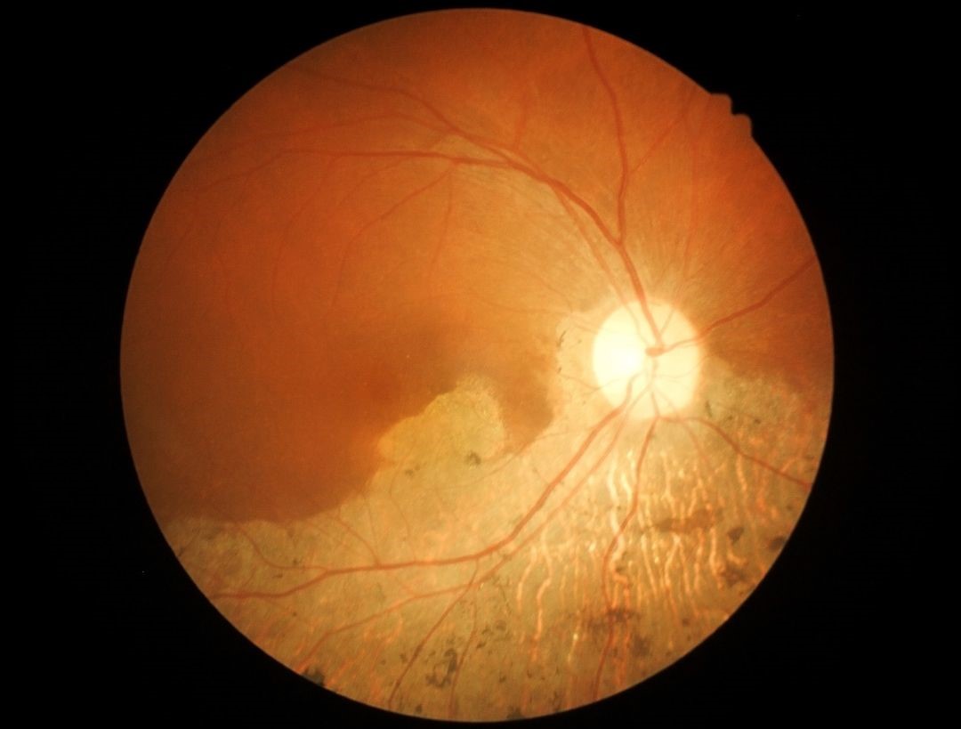 Does Macular Degeneration Cause Blindness Global Eye Hospital Does Macular Degeneration Cause Blindness Global Eye Hospital